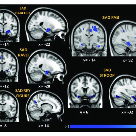 regions of significant correlation between gm density and sad for the