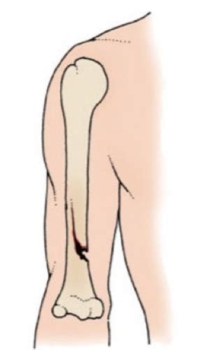 Fractures Flashcards Quizlet