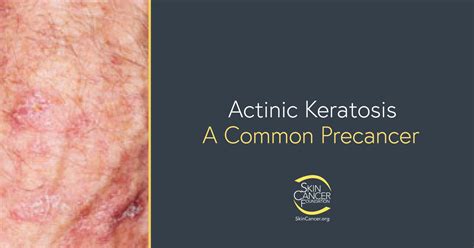 Actinic Keratosis Treatment
