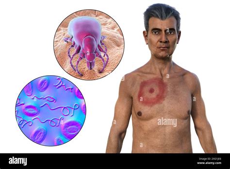 Illustration Showing Erythema Migrans A Characteristic Rash Seen In Patients With Lyme Disease
