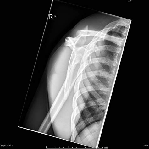 Radiopaedia Case Rockwood Ii Acromioclavicular Joint Injury With