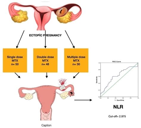 Methotrexate In Ectopic Pregnancy Asnachicago