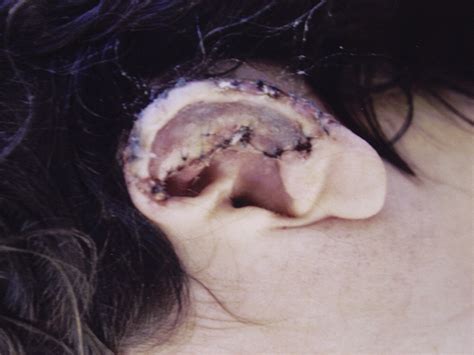 Delayed Bilateral Non Microvascular Ear Replantation After Violent