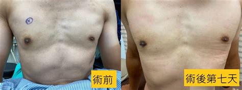 21歲男胸部突出超自卑 竟是「男性女乳症」、醫曝數字：35會這樣 健康 三立新聞網 Setncom