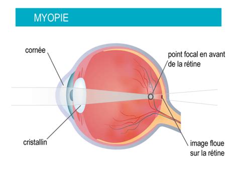 Tout Savoir Sur La Myopie