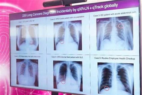 Ai Powered Technology For Early Lung Cancer Detection Now In Philippines Phnom Penh Post