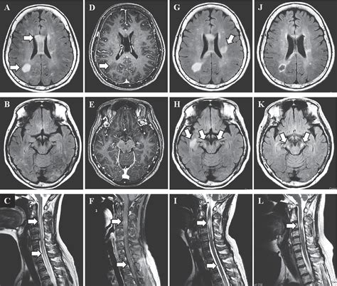 Figure 1 From The Neuromyelitis Optica Spectrum Disorders Semantic Scholar