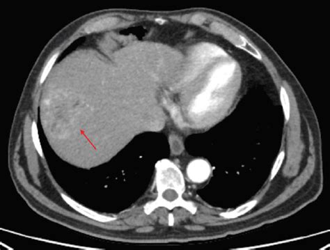 Selective Liver Embolization In Unresectable Multifocal Hepatocellular