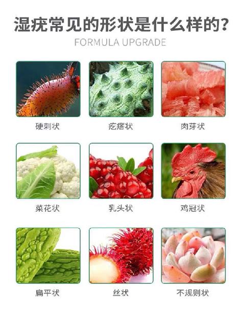 尖锐湿疣是什么样的？不是所有长在下面的疙瘩都是尖锐湿疣中国医疗