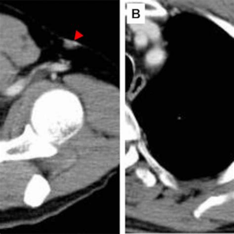 Computed Tomography Ct A Ct Shows An Irregular Mass In The Left