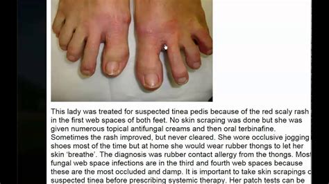 How To Get Rid Of Rubber Allergy At Jenny Abate Blog