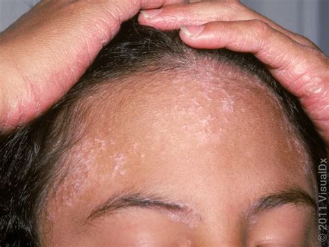 Heres What Psoriasis Looks Like Around The Body With Pictures Goodrx