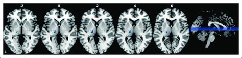 voxel based lesion symptom mapping results for the progression from