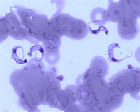 Chagas Disease Parasite Symptoms Complications Treatment