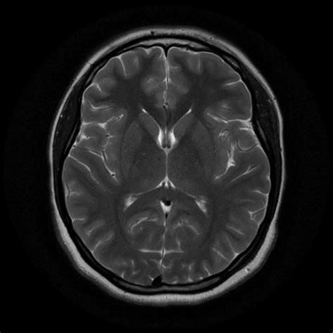 Normal Brain Mri Radiology Case Mri Brain Brain Scan Brain Images
