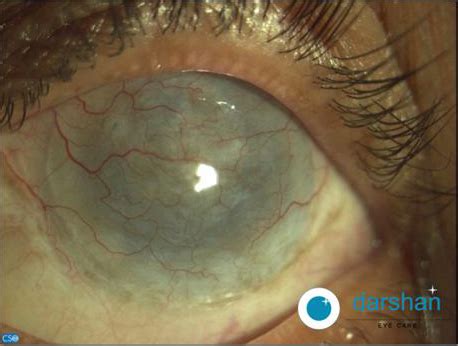 Conjunctival Hooding Causes Symptoms And Treatments