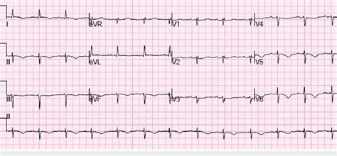 Twelve Lead ECG Showing Possible ST Segment Elevation In V5 V6 Poor R