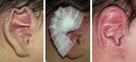Non Surgical Correction Of Deformational Auricular Anomalies Journal