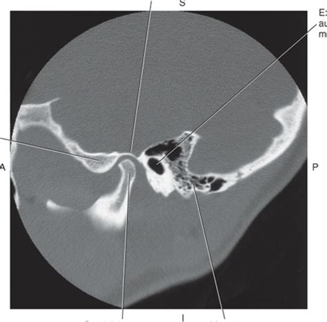 Sagittal Ct Of Tmj Diagram Quizlet