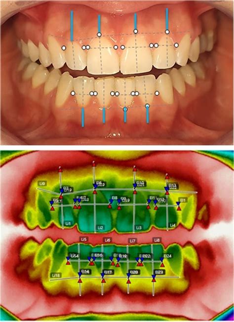 Reference Points Traced On The Photo Clinical And Thermograms