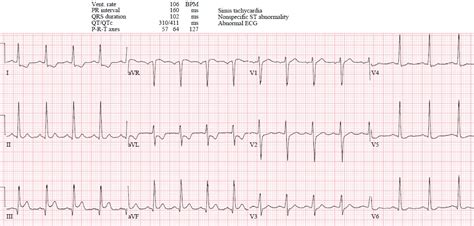 T Wave INVERSION Mnemonic ECG Cases Emergency Medicine Cases