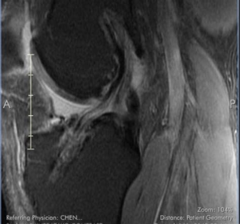 Partial Acl Tear W Meniscus R Acl