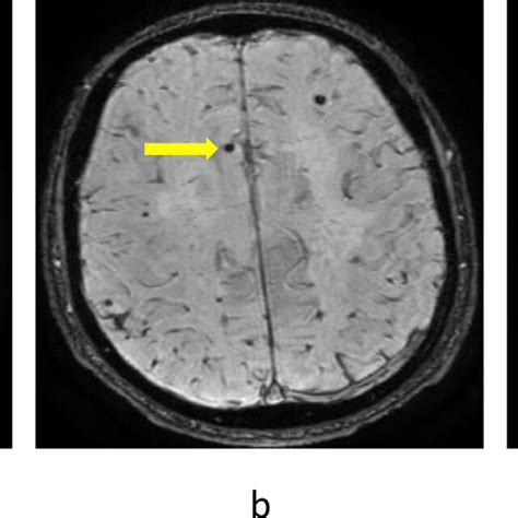 Neuroimaging Characteristics Of Cerebral Microbleeds Cmbs In Mr Download Scientific Diagram