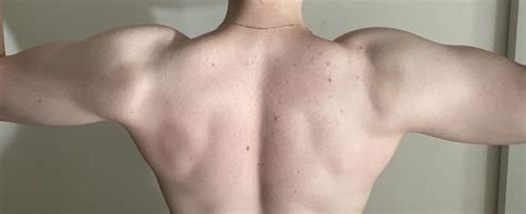 Left Side Smaller Thoracic Outlet Syndrome Rfitnessde