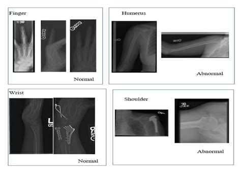 1 challenges in classifying body part x ray images by festina ismali gan based data