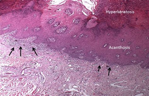 Figure5 Showing Stratified Squamous Epithelium With Excessive Download Scientific Diagram
