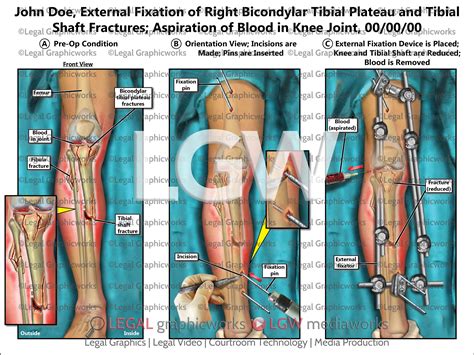 External Fixation Of Right Bicondylar Tibial Plateau And Tibial Shaft