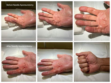 Dupuytrens Contracture Treatment By Dr Erickson In Raleigh