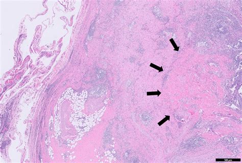 Pathology Outlines Interval Appendicitis