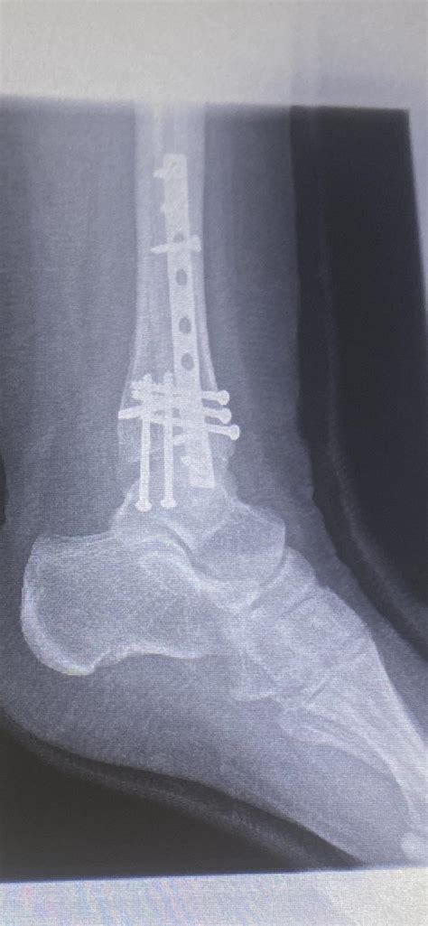 12 Weeks Post Orif And Syndesmosis Repair Brokenbones