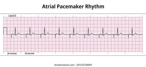 Pacemaker Rhythm Strips