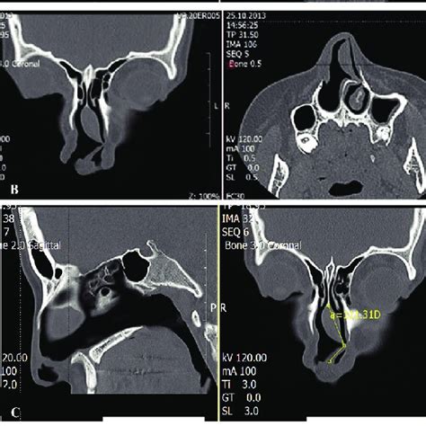 A D Preoperative Paranasal Sinus Ct Views Download Scientific Diagram