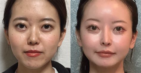 地獄の両顎＋輪郭3点のダウンタイムまとめ〜頬ピンが外れ頬骨が割れていた件〜｜渡韓整形y子ちゃん
