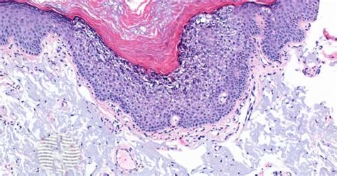 Epidermolytic Hyperkeratosis Pathology Image