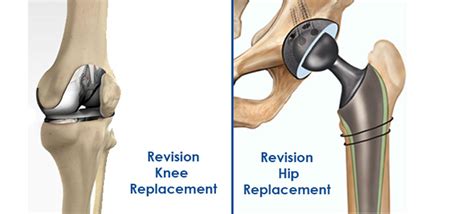 Revision Knee And Hip Replacements