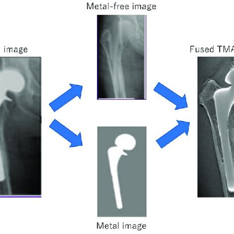 Brief Image Of Tomosynthesis With Metal Artifact Reduction Tmar Download Scientific Diagram