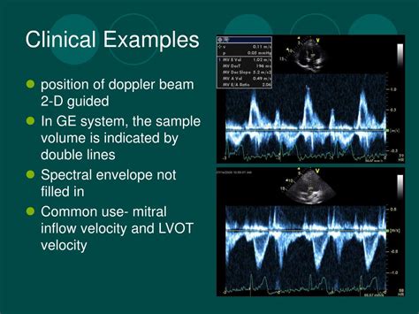 PPT Doppler Echocardiography PowerPoint Presentation Free Download ID 1113101