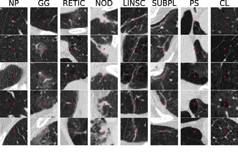 [pdf] Classification Of Interstitial Lung Abnormality Patterns With An Ensemble Of Deep
