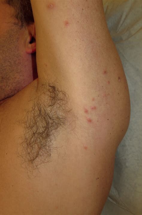 Prurigo Simplex Or “itchy Red Bump” Disease Review And Case Series Pmc