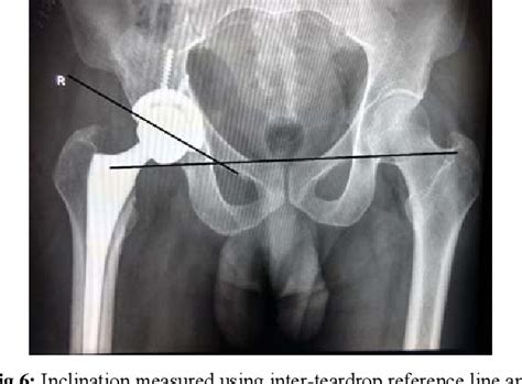 Figure 3 From The Orientation Of Acetabular Component In Total Hip Replacement Using Transverse