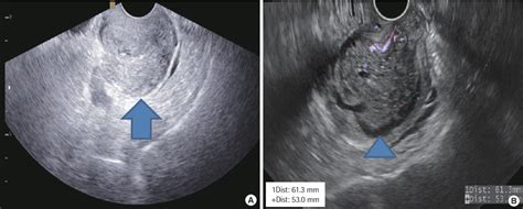 Figure 1 From Prevotella Bivia Infection Following Supracervical
