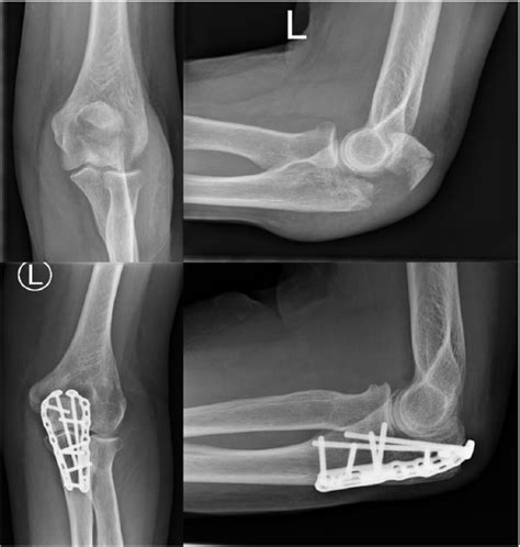 Ulna Hairline Fracture