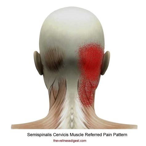 Semispinalis Cervicis Muscle Head And Neck Pain The Wellness Digest