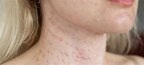 Vasculitis Dr Veena Patel