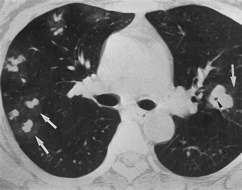 Ct Metastatic Lung Cancer