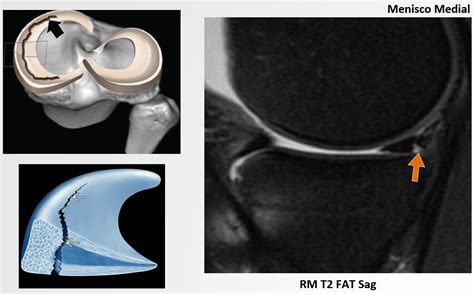 Lesão Meniscal